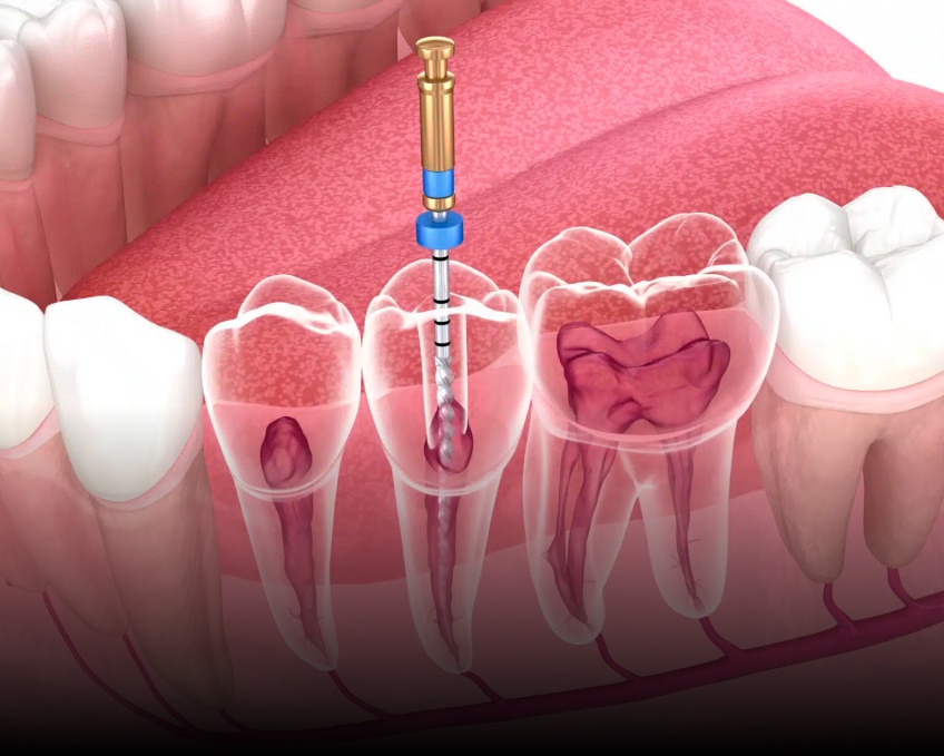 Endodoncia - Vitales